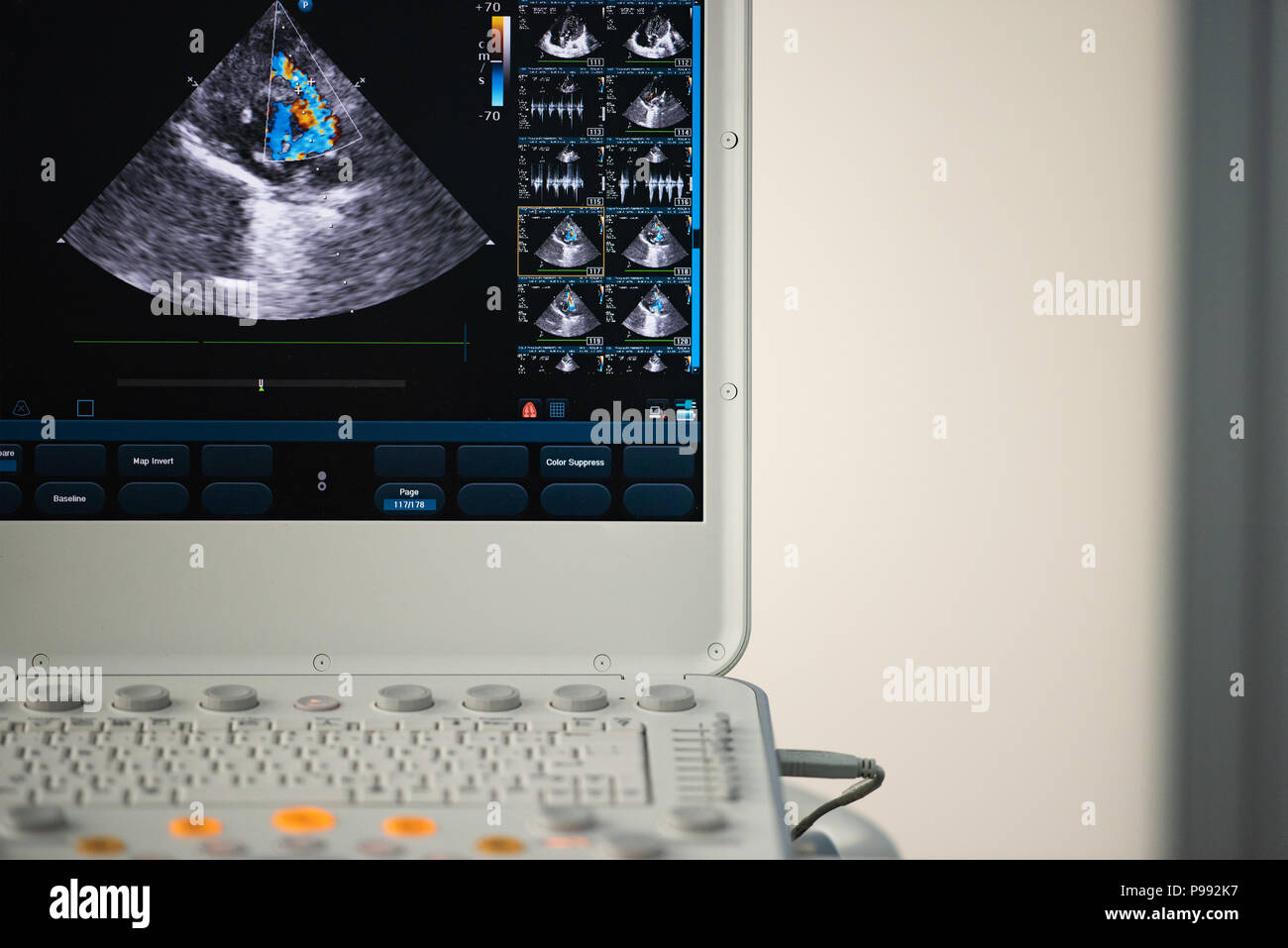 Echocardiogram procedure hi-res stock photography and images - Alamy