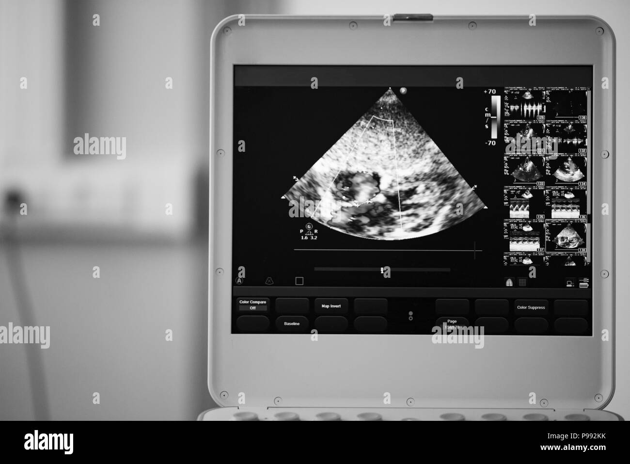 On the screen of a modern ultrasound scanner, a heart image with an ...