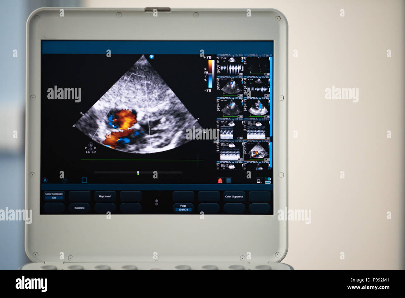 Echocardiogram procedure hi-res stock photography and images - Alamy