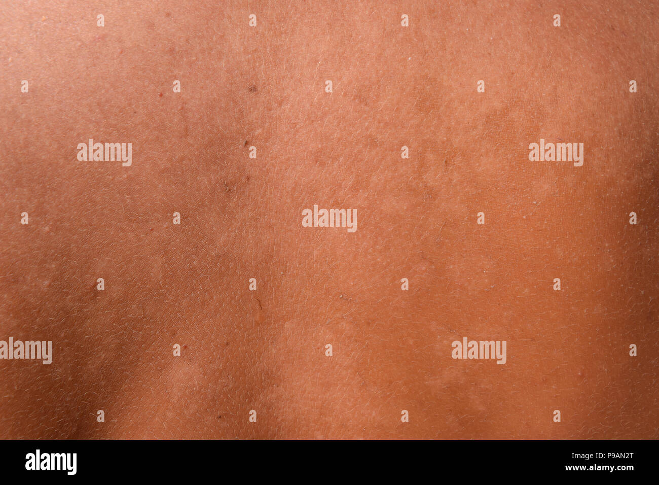 Sunburn on the skin of the back. Exfoliation, skin peels off. Dangerous ...