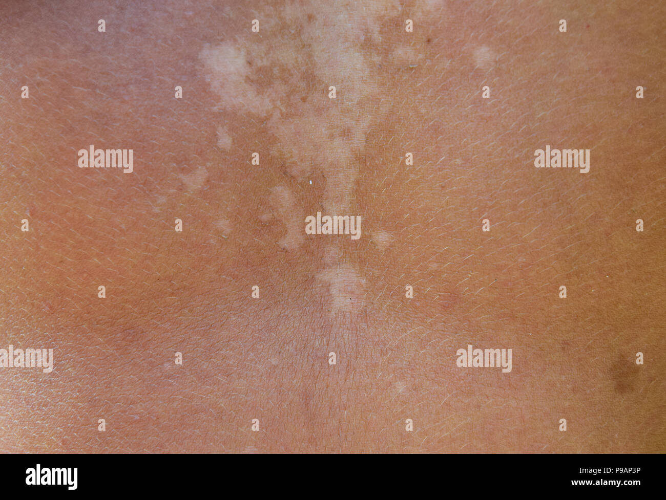 Sunburn on the skin of the back. Exfoliation, skin peels off. Dangerous ...