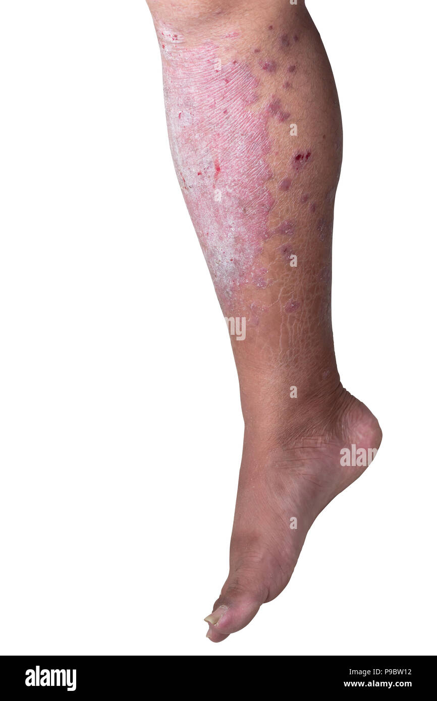 The Mans Leg Is Filled With Psoriasis Laid On The White Background With Clipping Paths