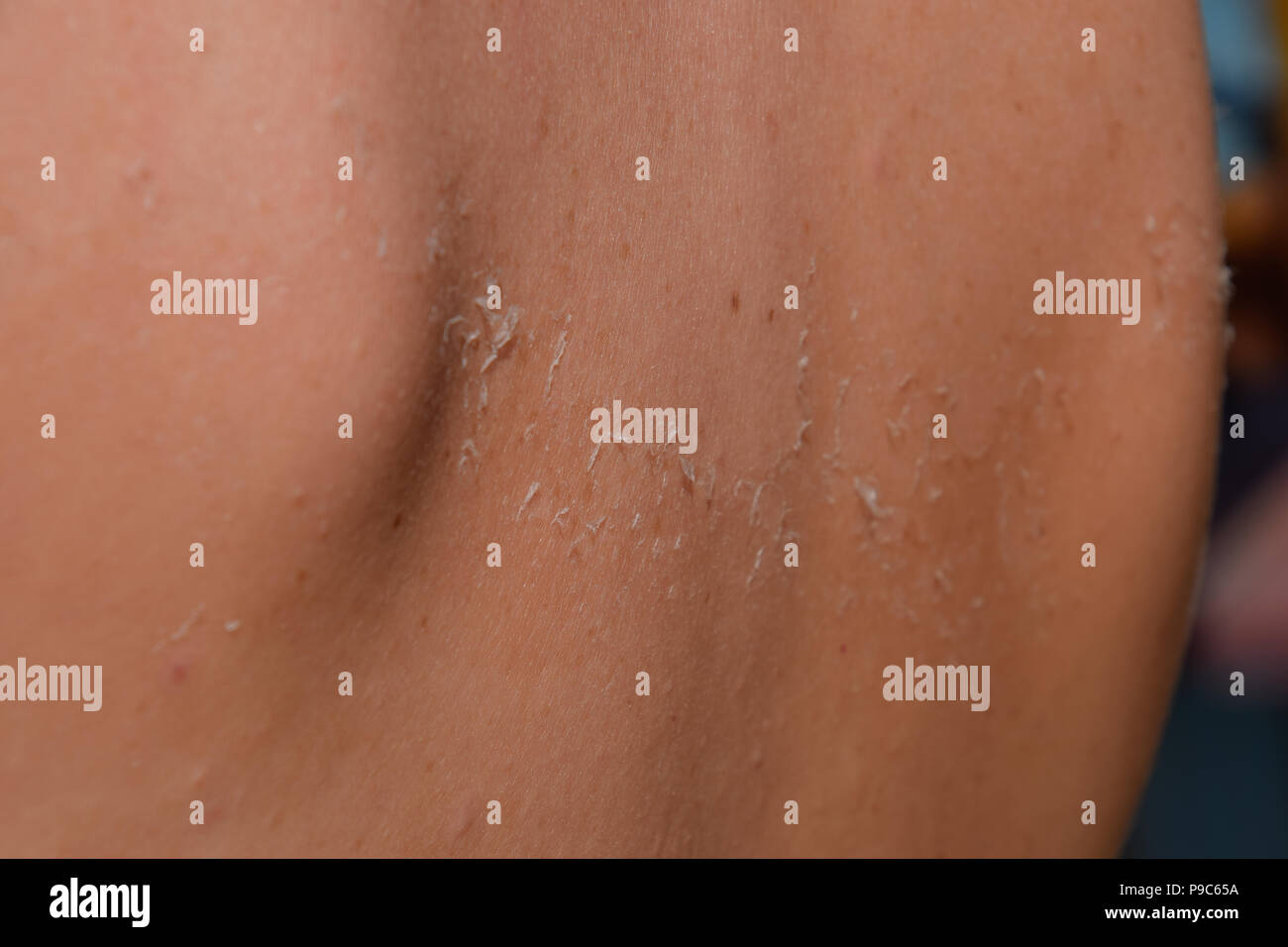 Sunburn on the skin of the back. Exfoliation, skin peels off. Dangerous ...