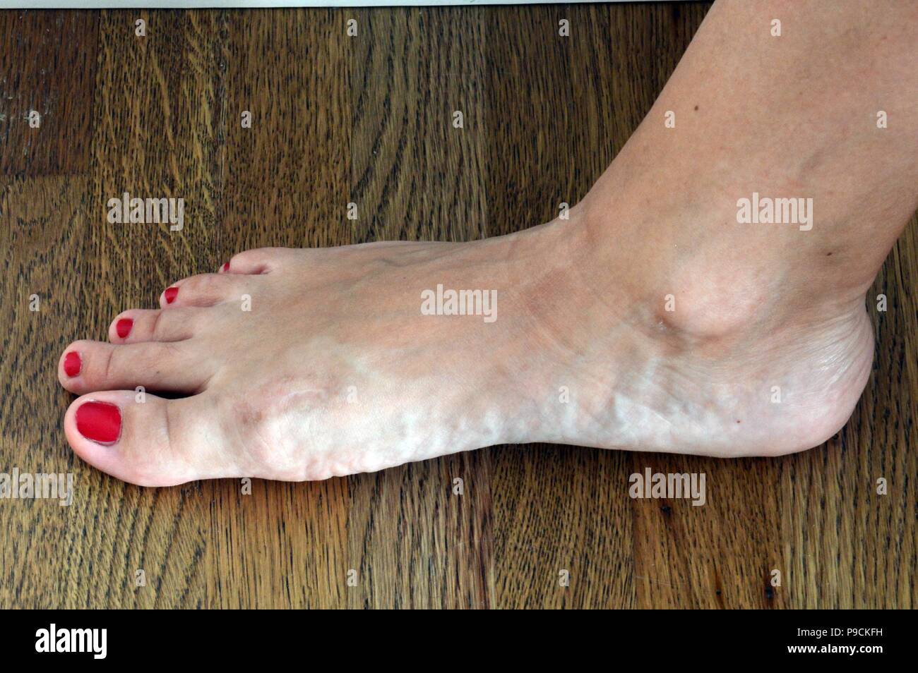 Hallux valgus surgery hi-res stock photography and images - Alamy