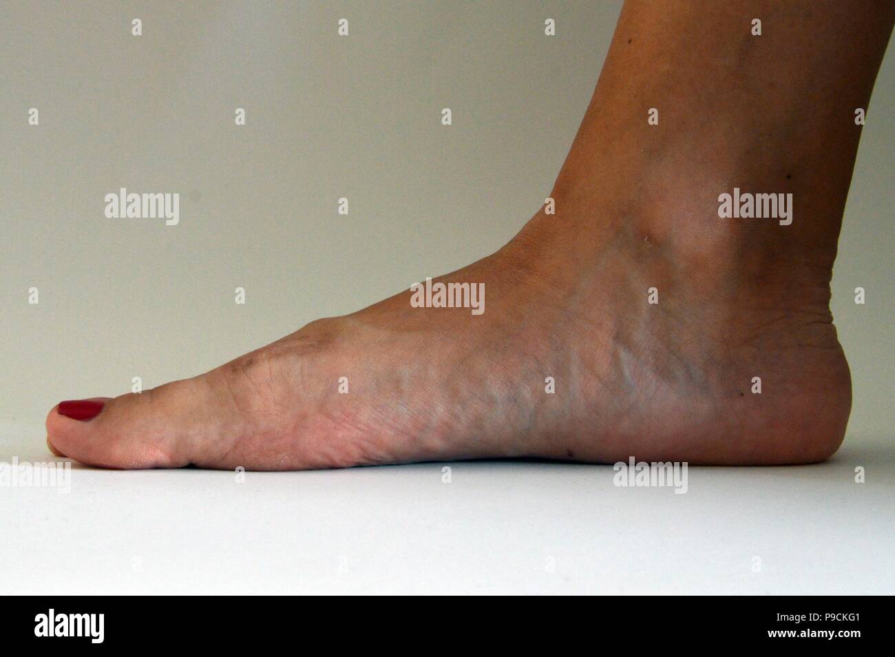 Hallux valgus hi-res stock photography and images - Alamy