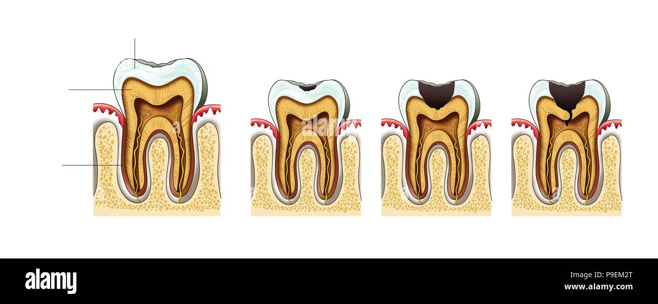Stages of tooth decay Stock Photo - Alamy