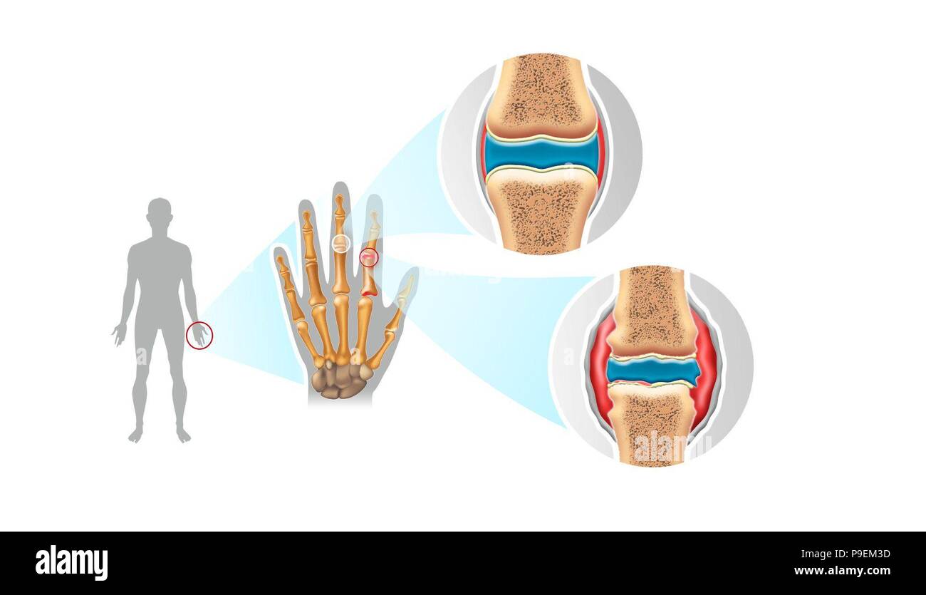 Arthritis synovitis hi-res stock photography and images - Alamy