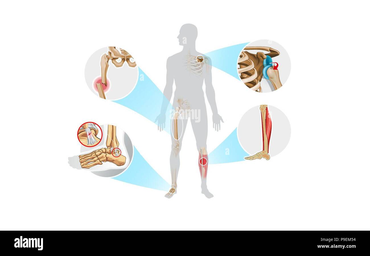 Musculoskeletal injuries hi-res stock photography and images - Alamy