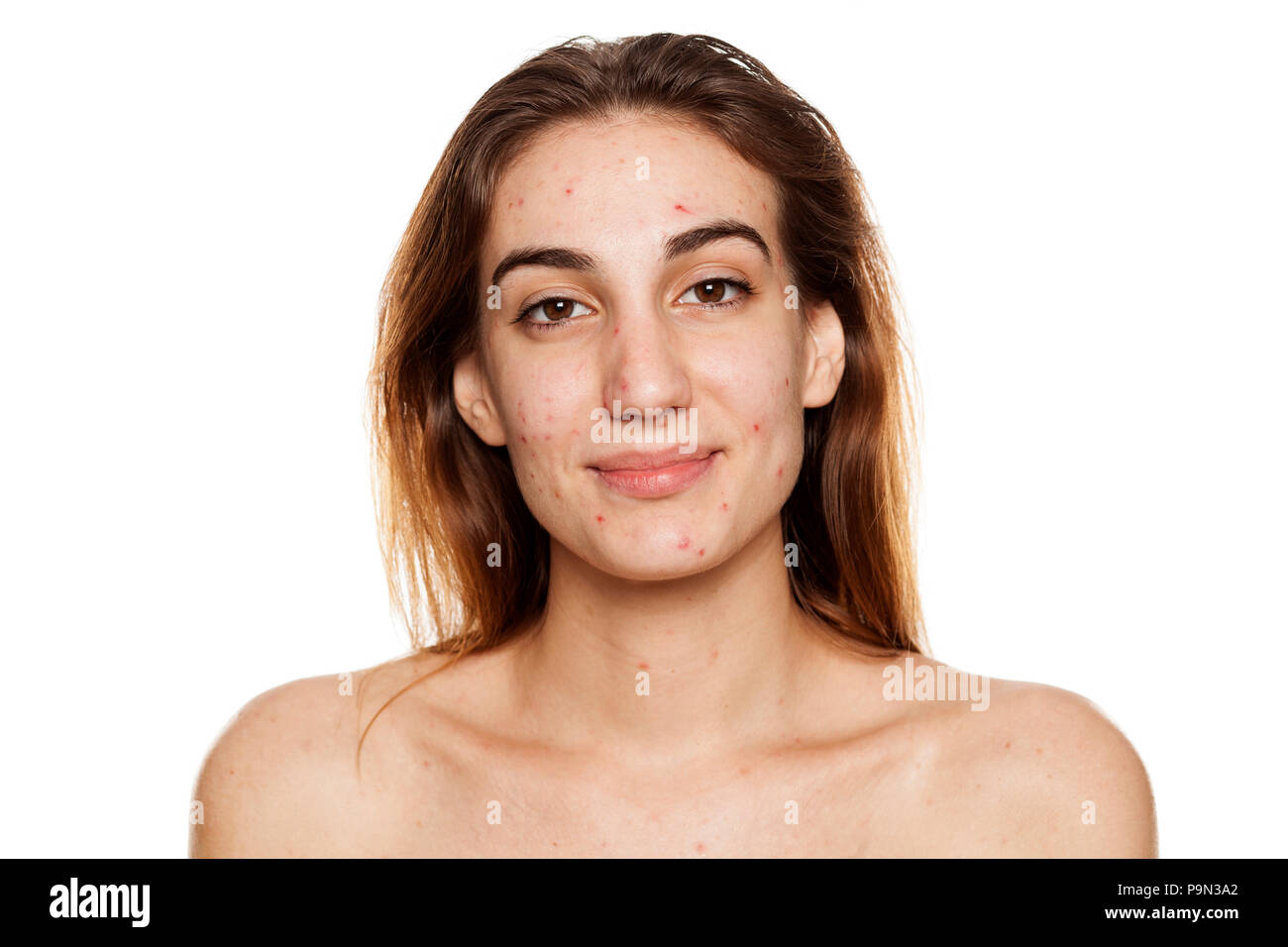 young smiling woman with problematic skin and without makeup poses on a ...