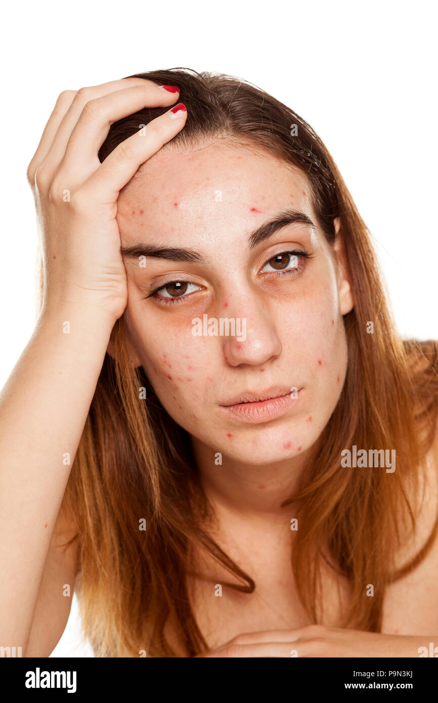 Heroin Addiction Eyes