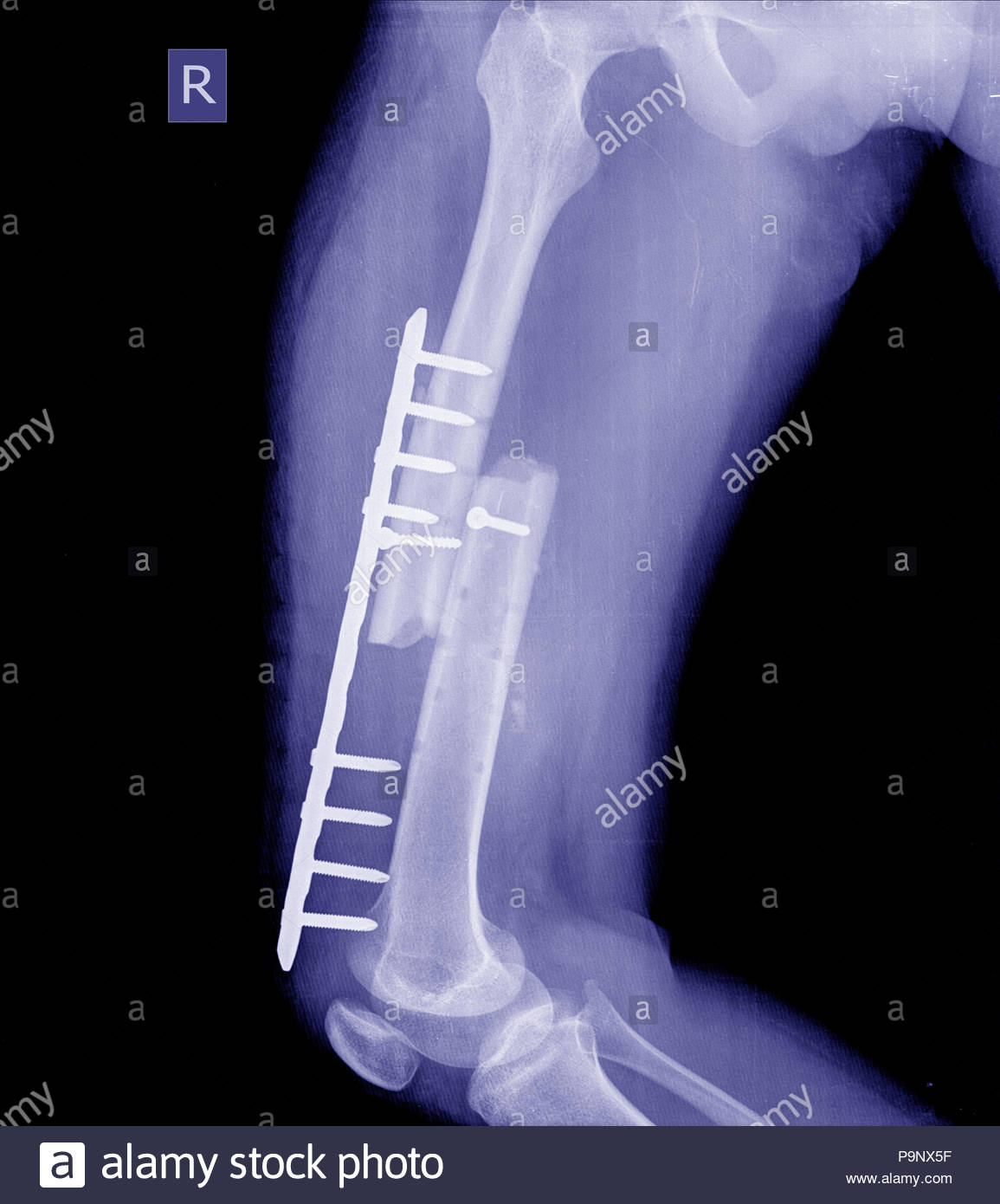 Fractured Ankle Stock Photos & Fractured Ankle Stock Images - Alamy