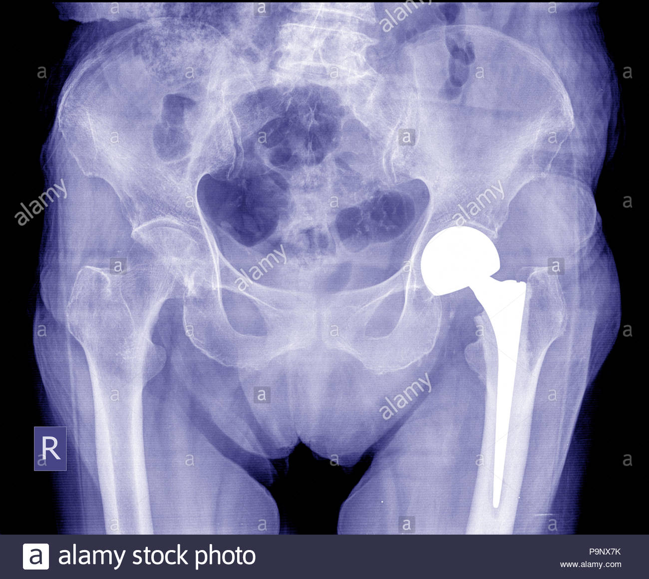 Osteoporosis Bone Scan Stock Photos & Osteoporosis Bone Scan Stock ...