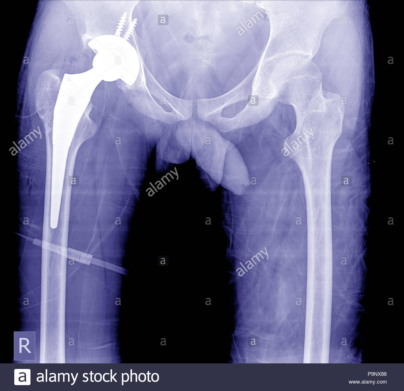Osteoporosis Bone Scan Stock Photos & Osteoporosis Bone Scan Stock ...