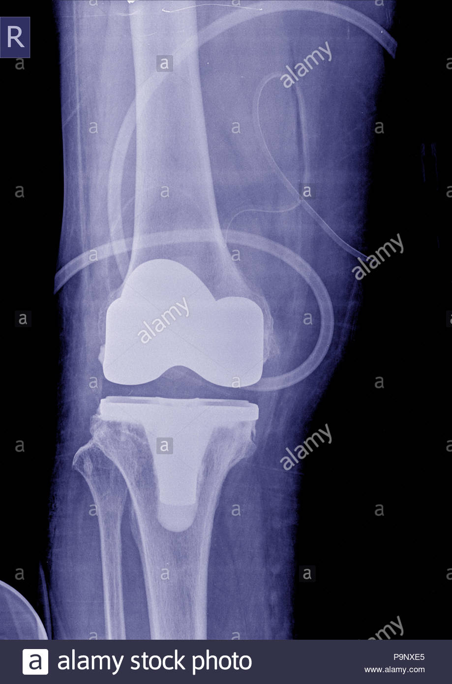 Osteoporosis Bone Scan Stock Photos & Osteoporosis Bone Scan Stock ...