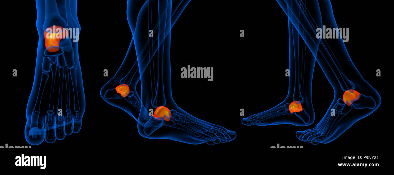 Lateral malleolus fracture hi-res stock photography and images - Alamy