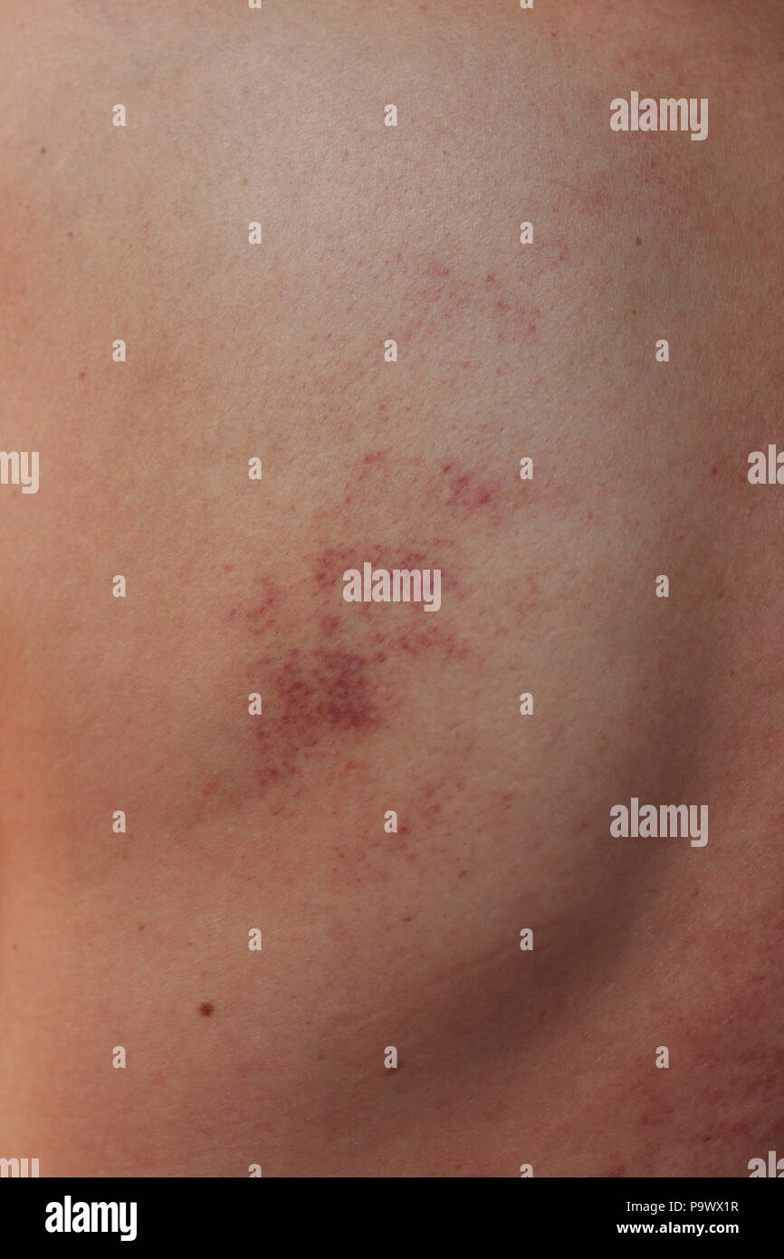 Ecchymosis hi-res stock photography and images - Alamy