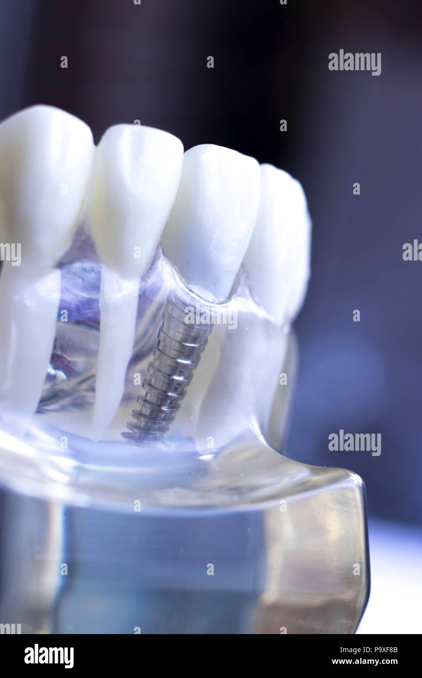 Dentist dental teeth teaching model showing titanium metal tooth ...