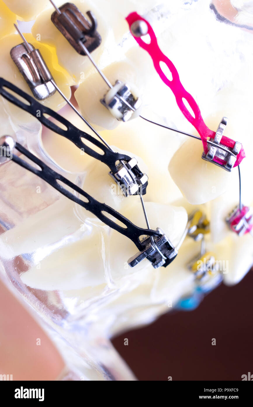 Dental metal braces teeth retainer aligners teaching orthodontics model ...