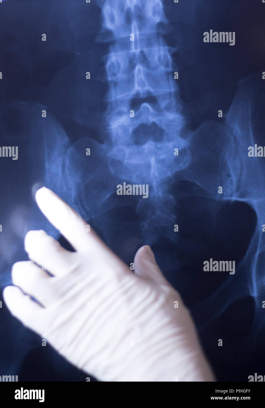 Medical hospital x-ray lowe back pain spine and hips traumatology scan ...