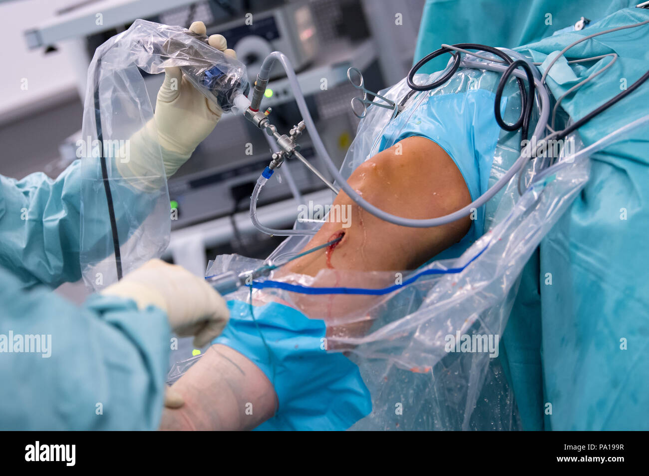 Knee Replacement Surgery Stock Photos & Knee Replacement Surgery Stock ...