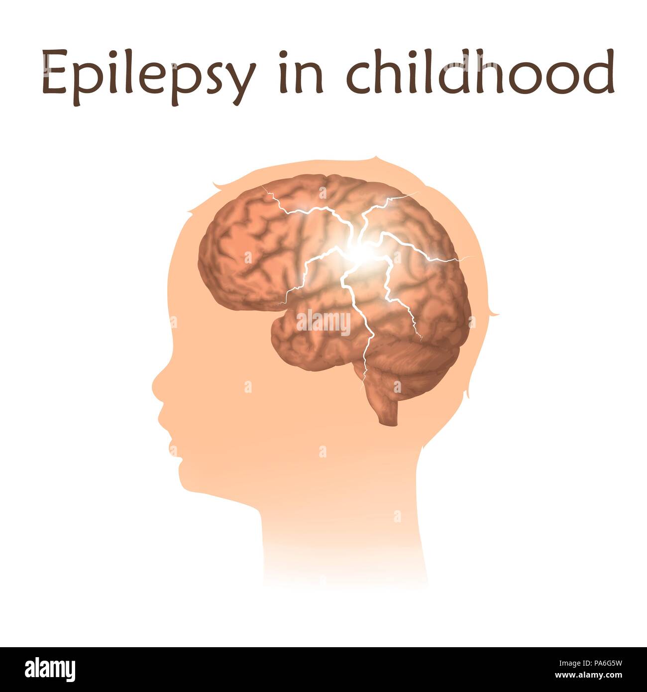 Childhood epilepsy, illustration. Electrical discharge in a child's ...