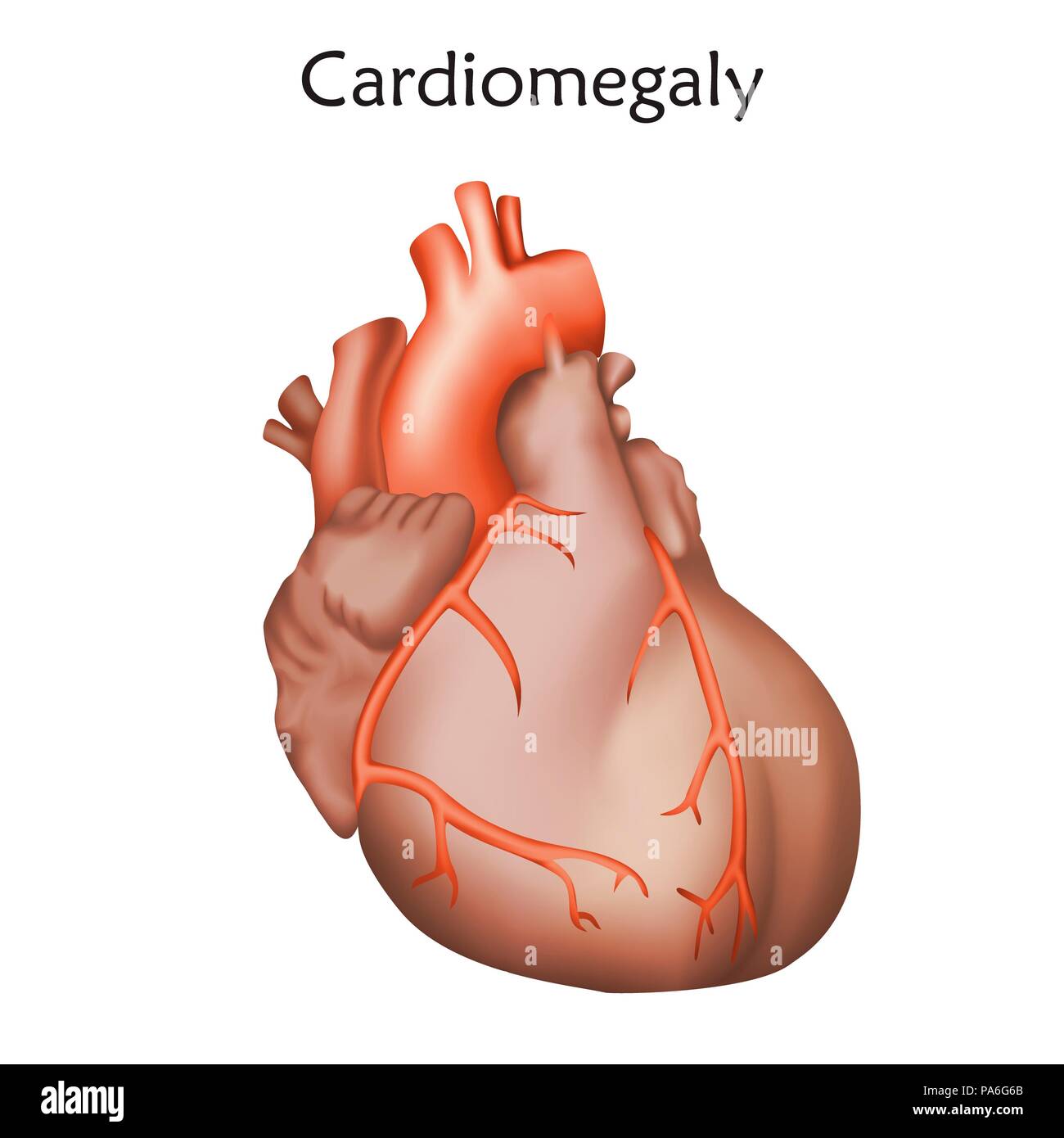 Cardiomegaly hi-res stock photography and images - Alamy