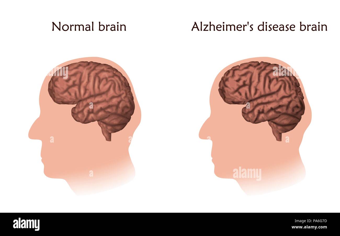 Alzheimer brain comparison hi-res stock photography and images - Alamy