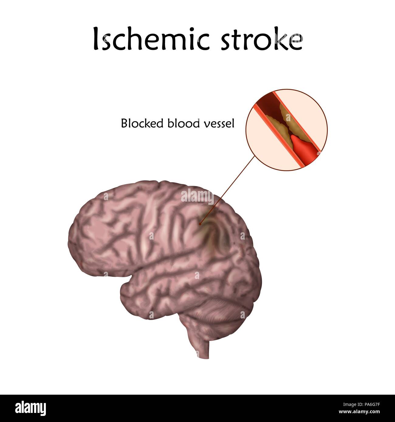 Ischemic stroke, illustration. Blocked blood vessel causing an ischemic ...
