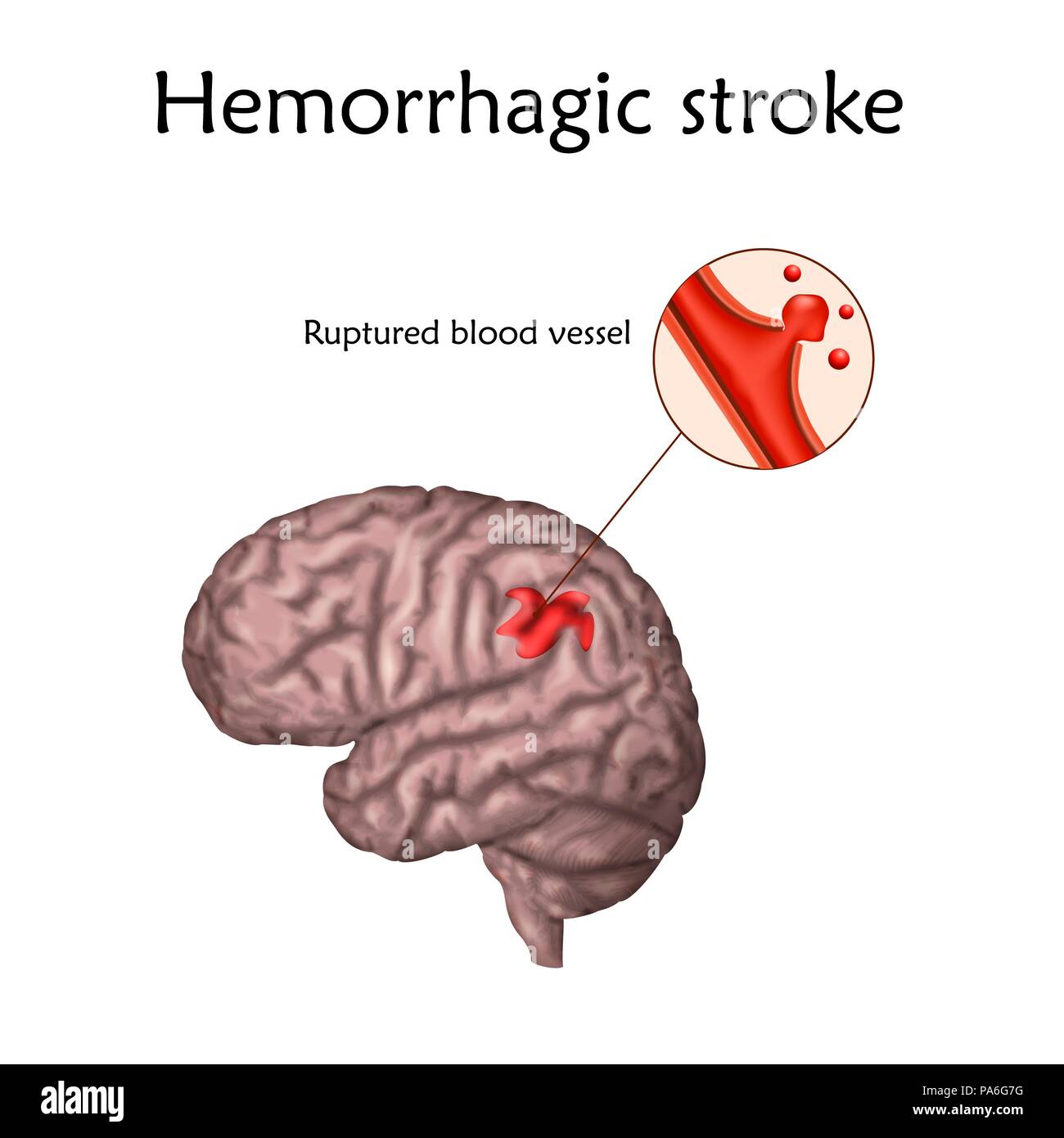 Haemorrhagic hi-res stock photography and images - Alamy