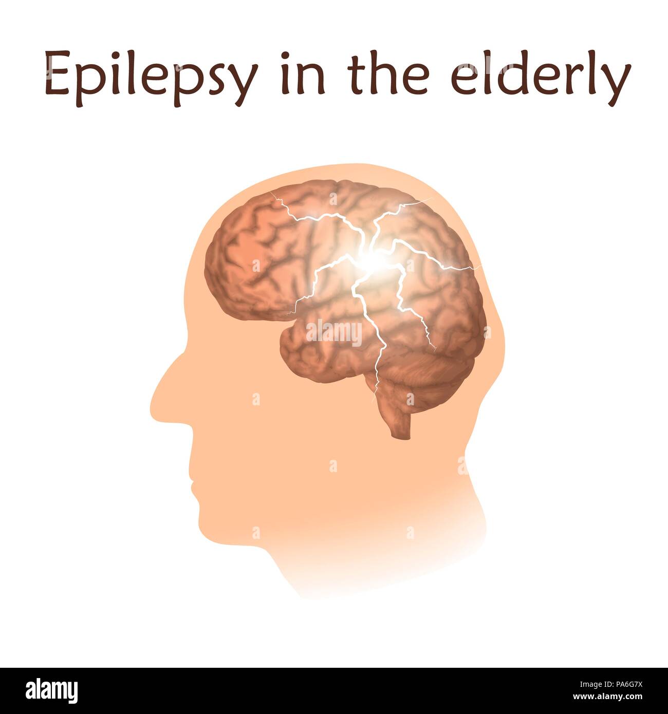 Epilepsy brain hi-res stock photography and images - Alamy