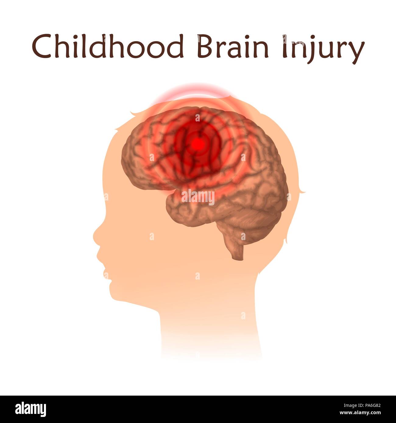 Childhood brain injury, illustration. Damaged child's brain Stock Photo ...