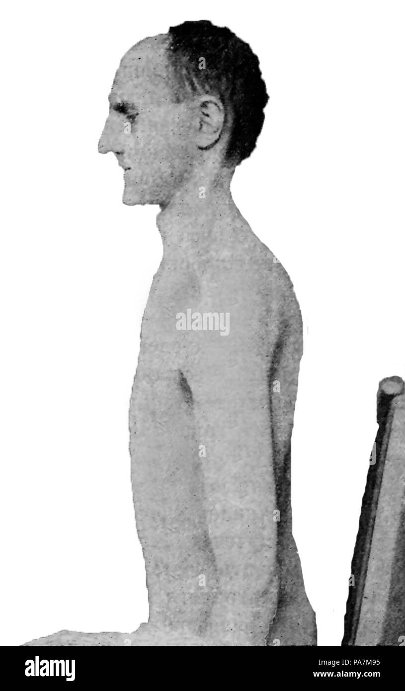 Asthenic hi-res stock photography and images - Alamy