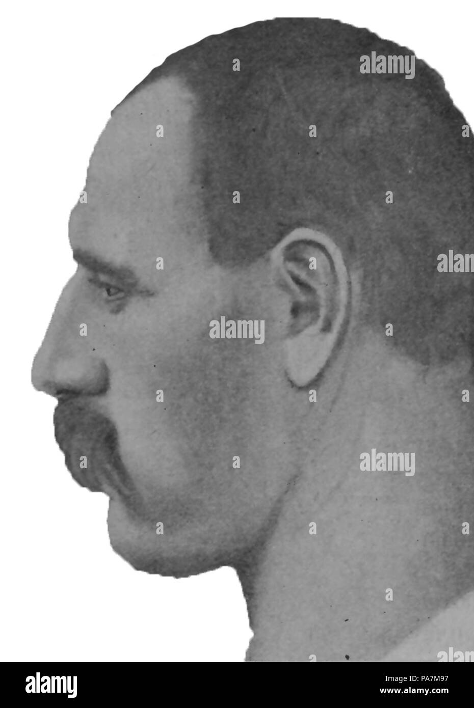 Acromegaly hi-res stock photography and images - Alamy