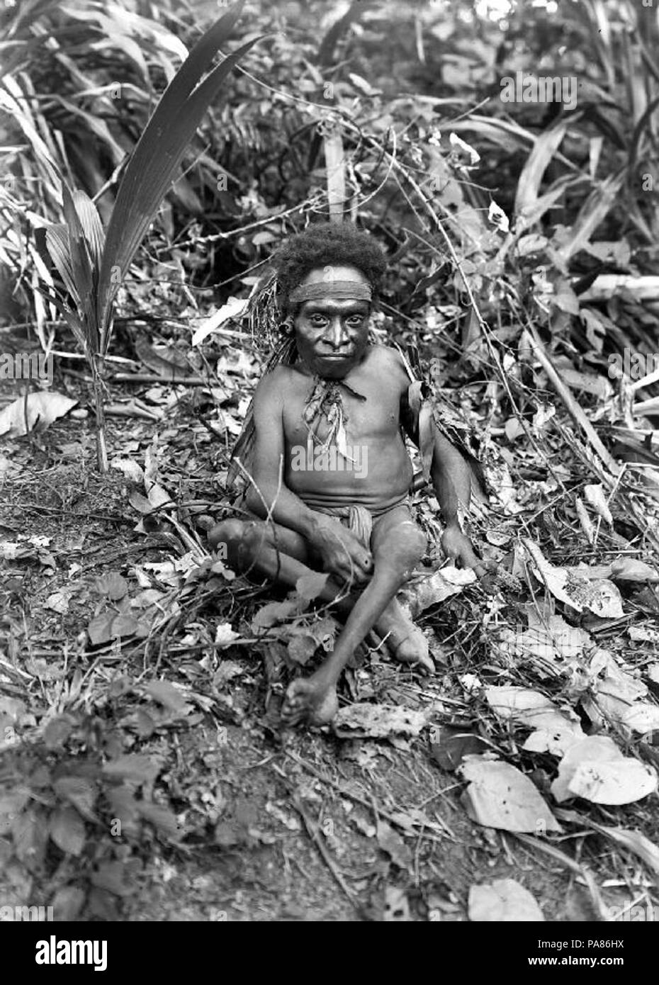 72 Een Demta (Jaifor) Papoea met door ziekte ontstane vergroeiingen ...