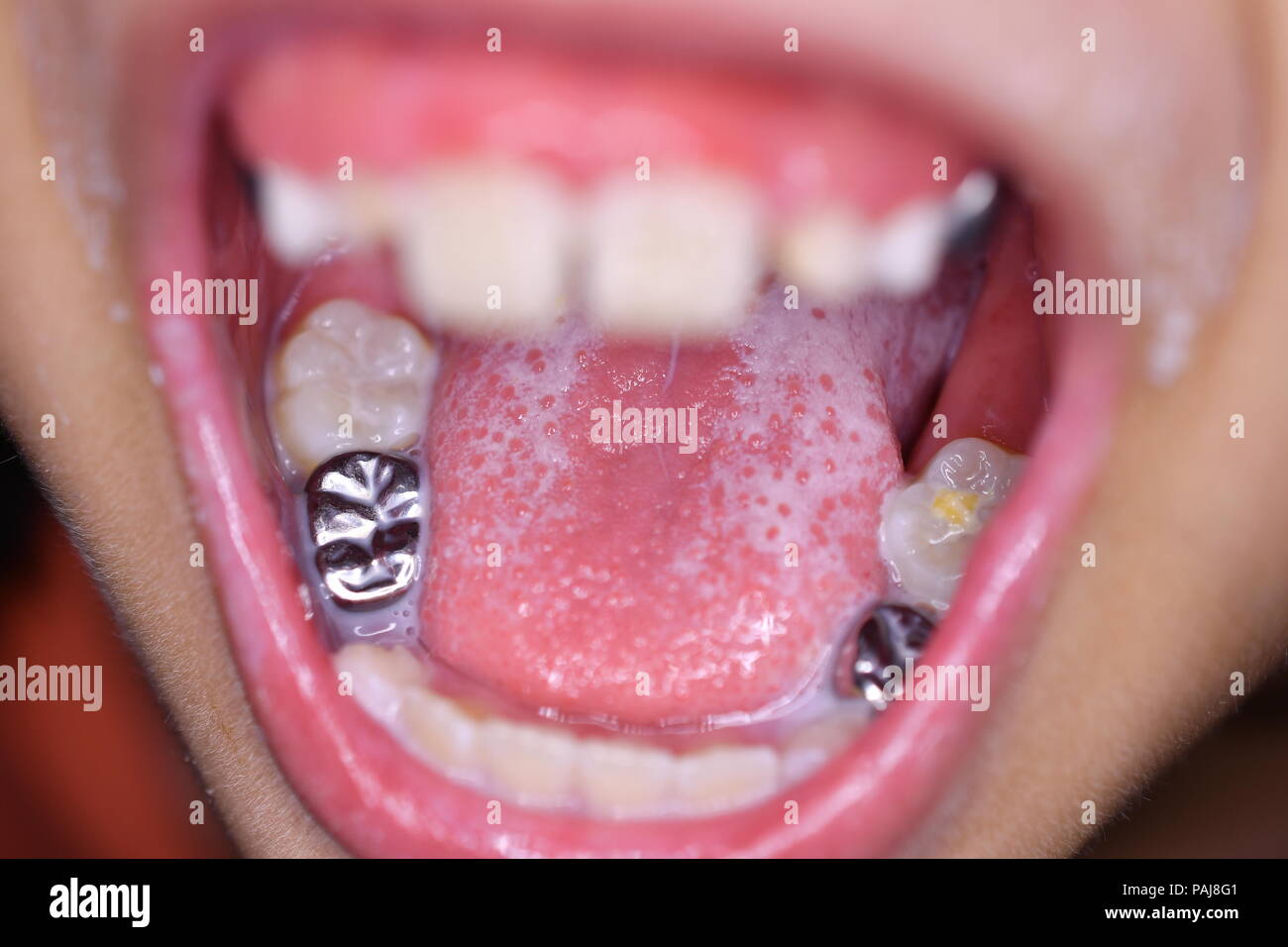 Molars Root canal and crowning Stock Photo - Alamy