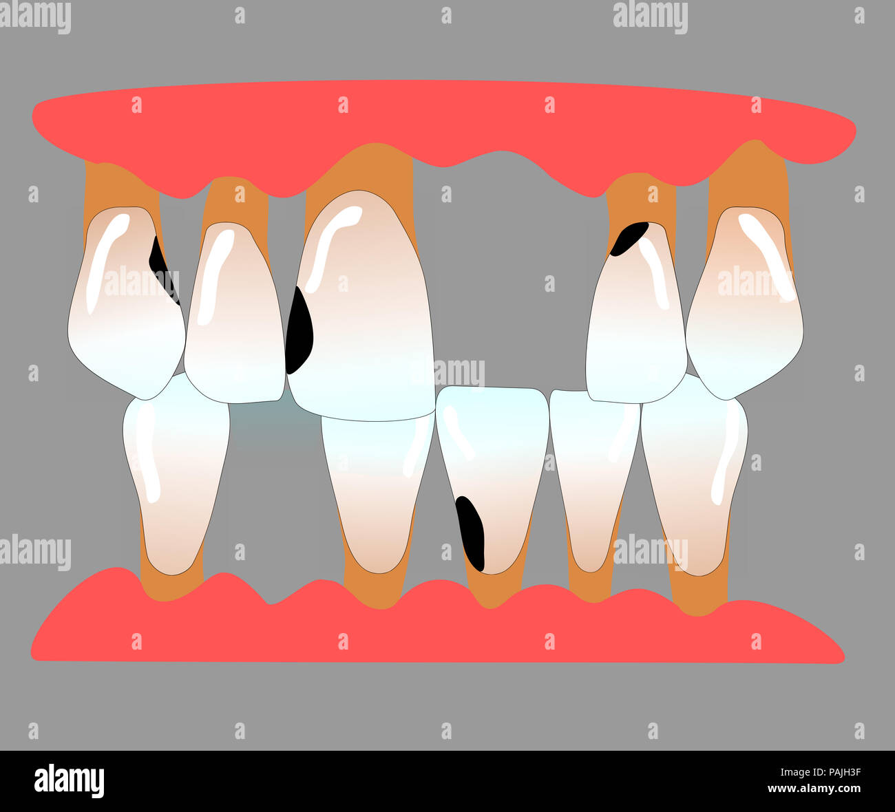 Periodontitis illustration hi-res stock photography and images - Alamy