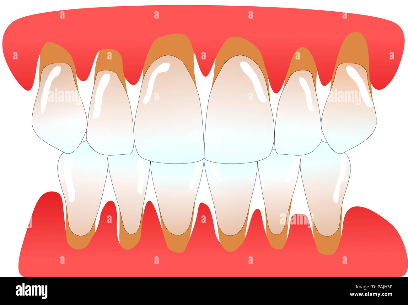 illustration of frontteeth with periodontitis and caries Stock Photo ...