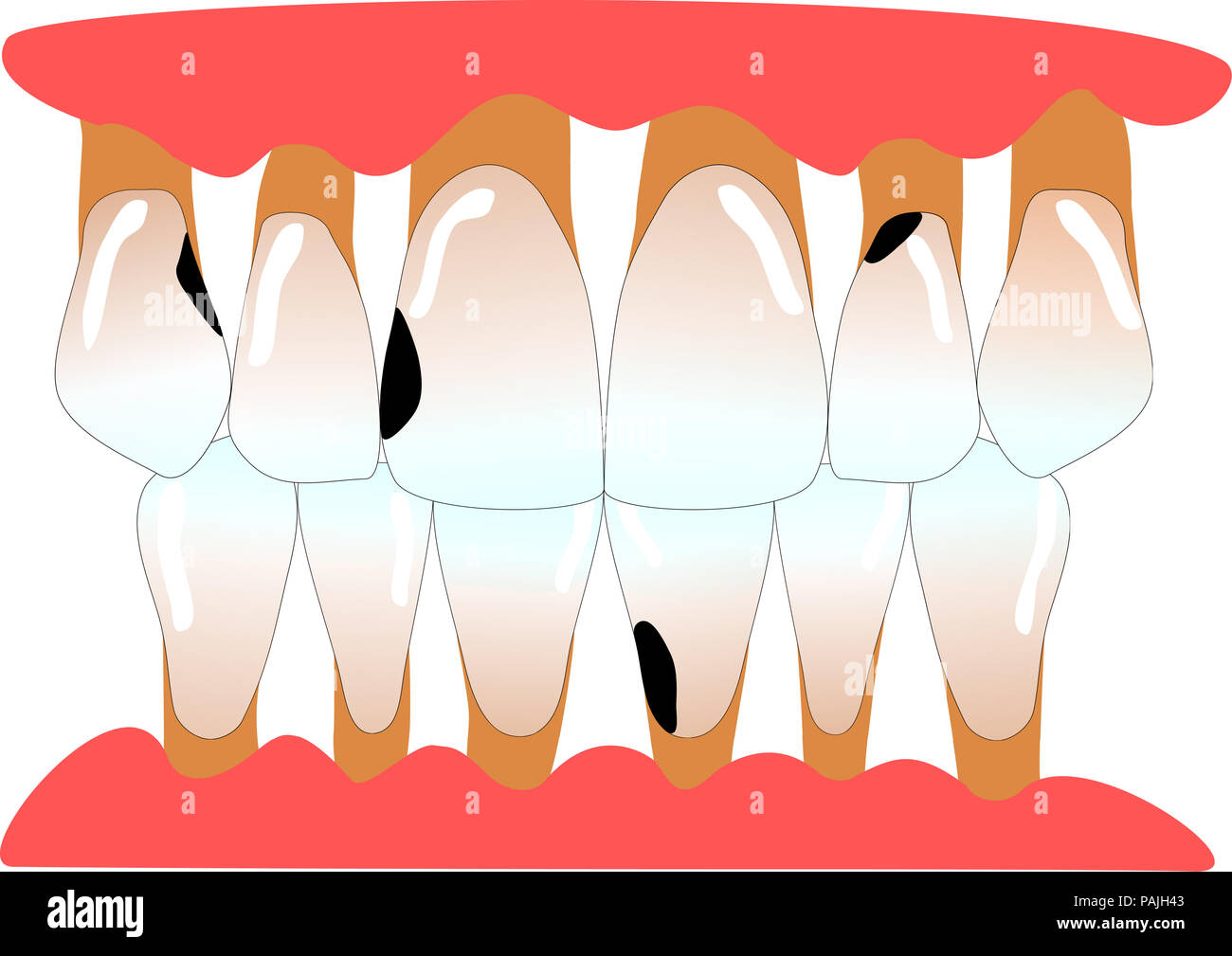 illustration of frontteeth with periodontitis and caries Stock Photo ...