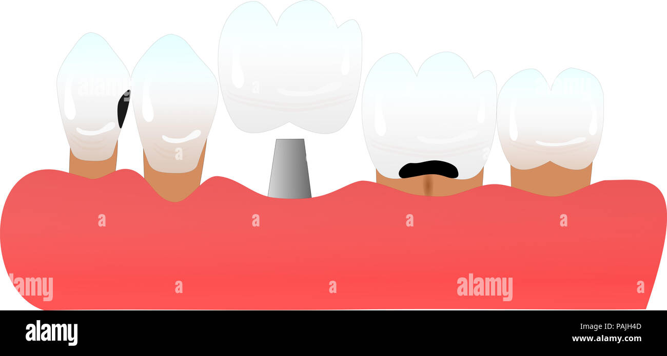 illustration od side teeth Stock Photo - Alamy