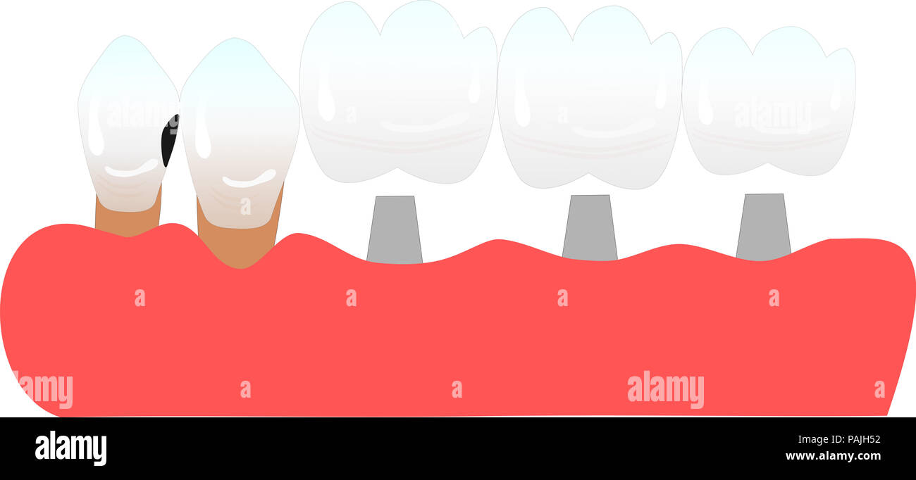 illustration od side teeth Stock Photo - Alamy