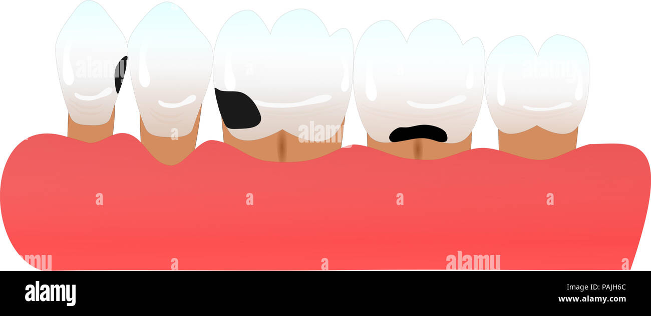 illustration of side teeth Stock Photo - Alamy