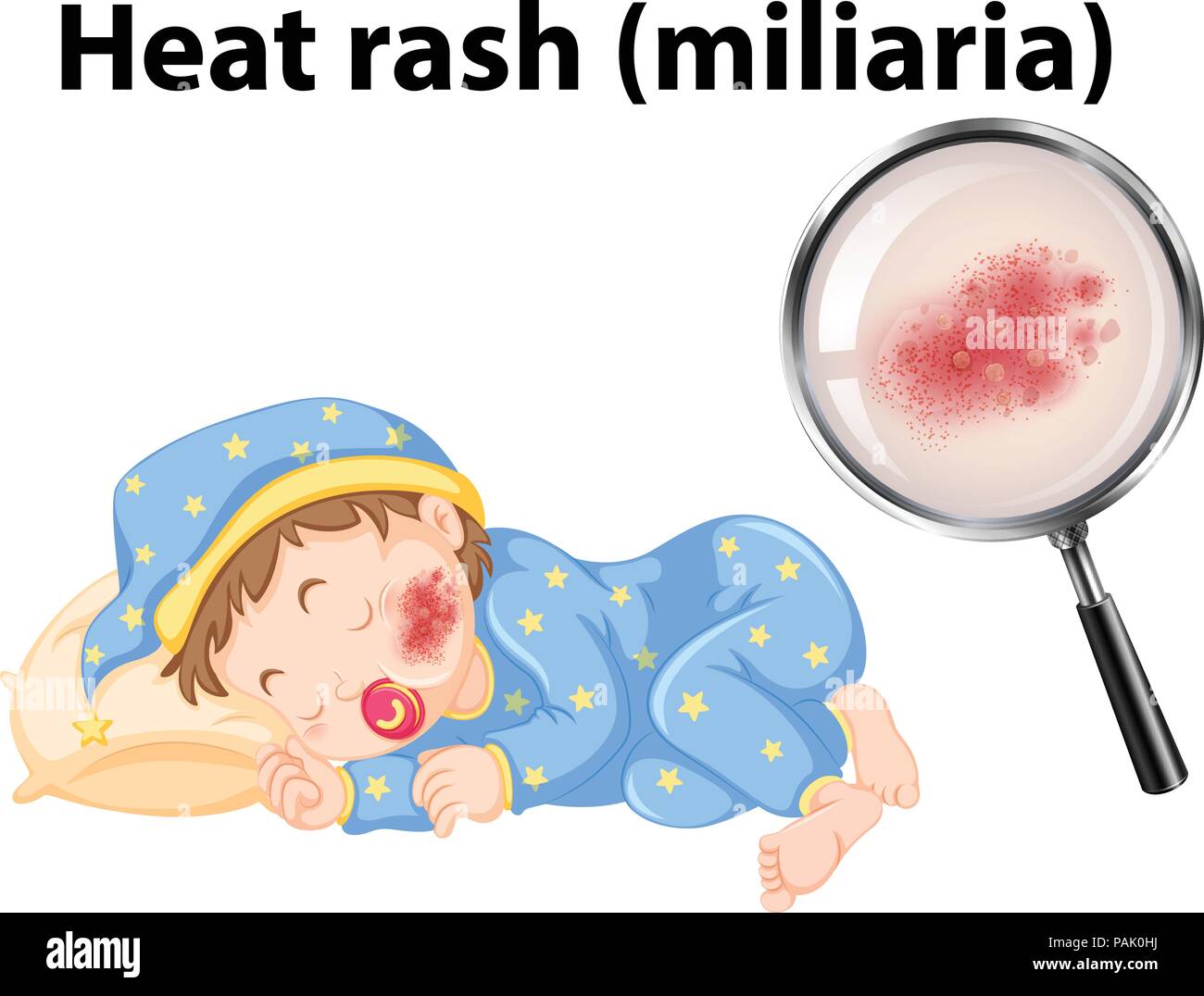 Skin rash vector vectors hi-res stock photography and images - Alamy