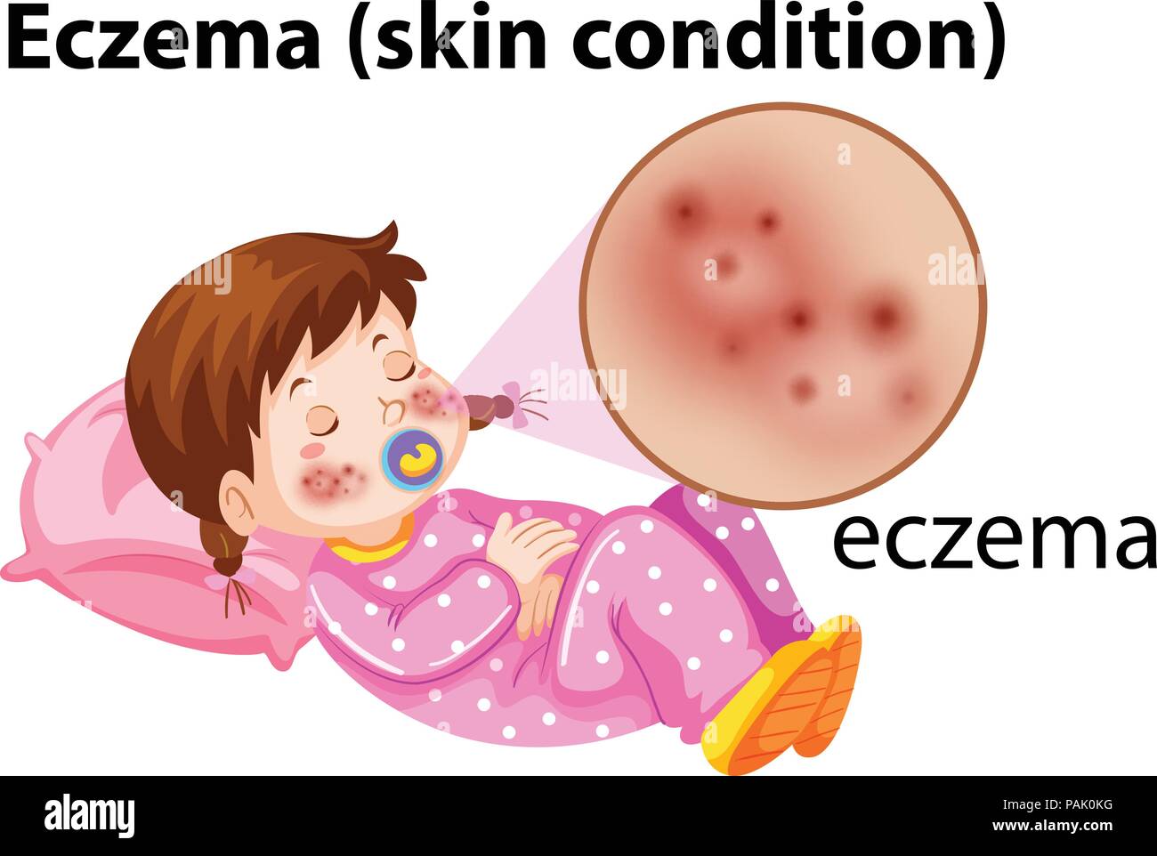 Eczema drawing hi-res stock photography and images - Alamy