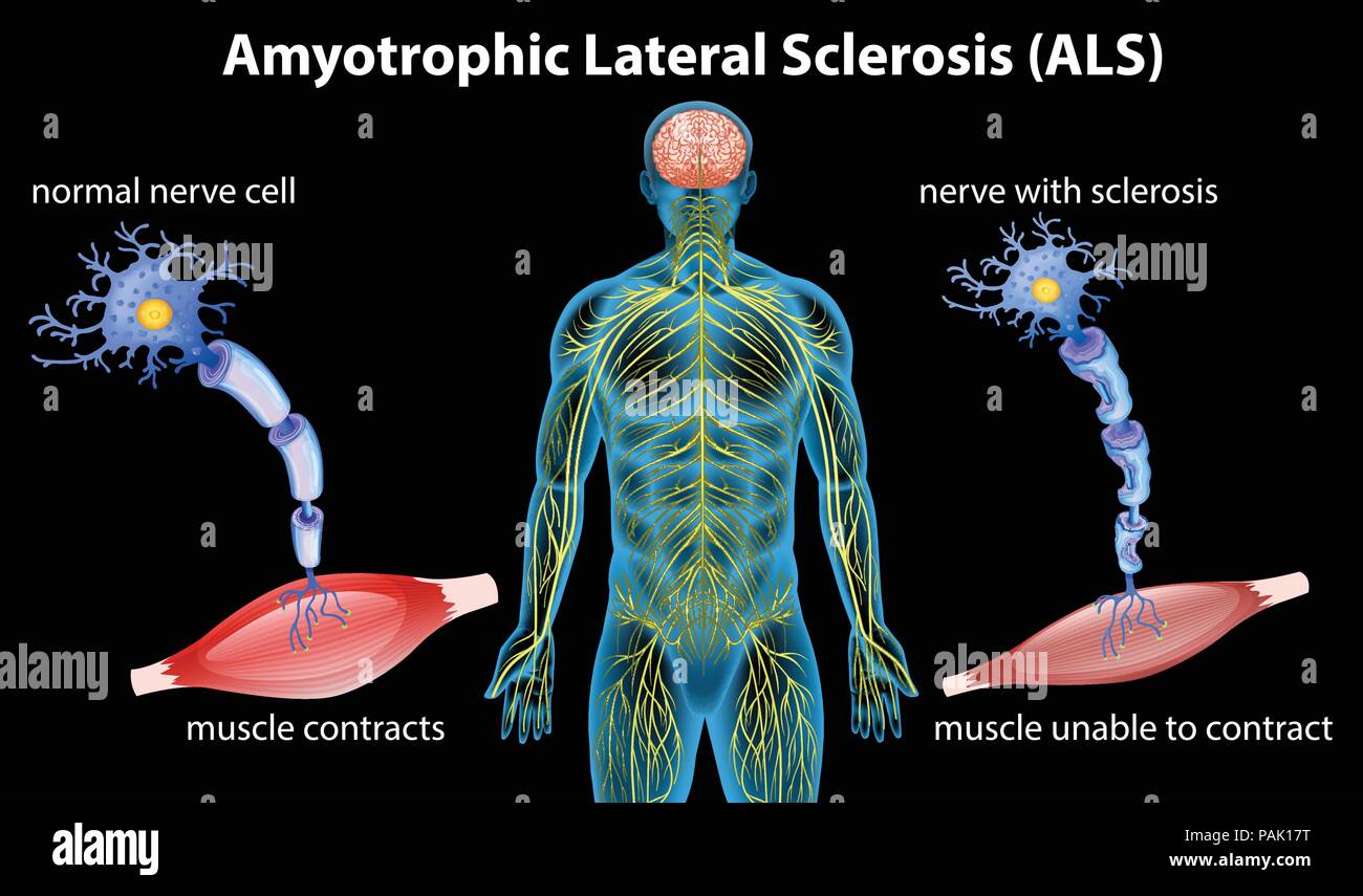 Amyotrophic lateral sclerosis and als Stock Vector Images - Alamy
