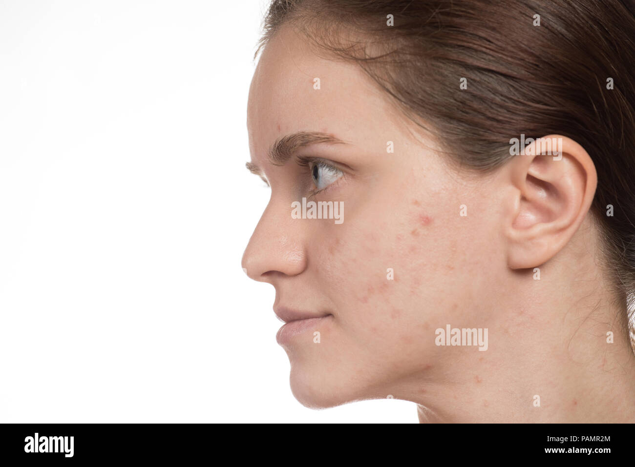 Beautiful young girl with red and white acne on her face. Before and ...
