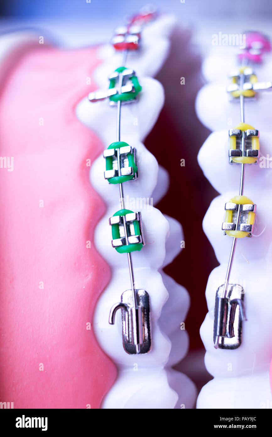 Dental metal braces teeth retainer aligners teaching orthodontics model ...