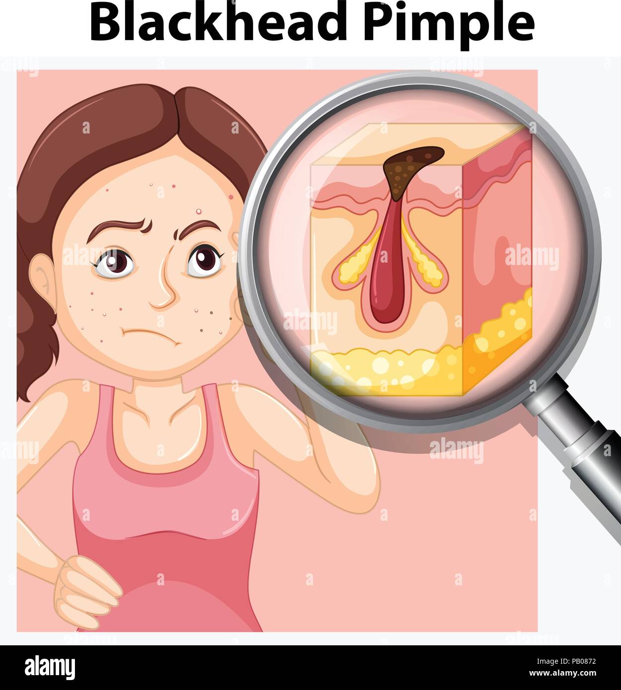 Pimple illustration hi-res stock photography and images - Alamy