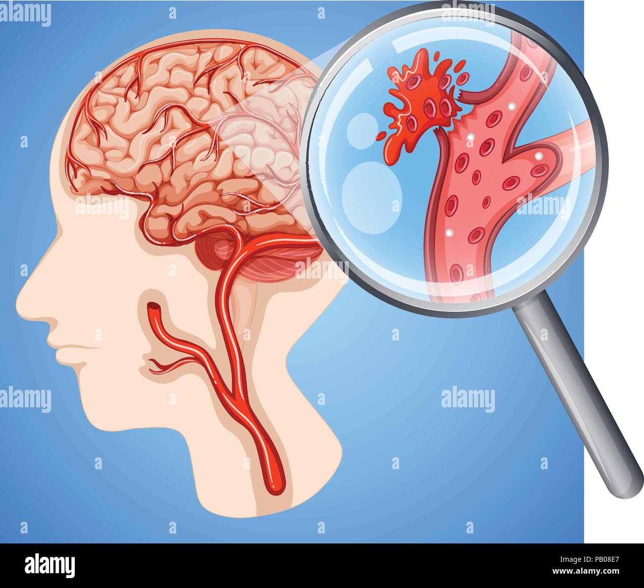 Small vessel disease hi-res stock photography and images - Alamy