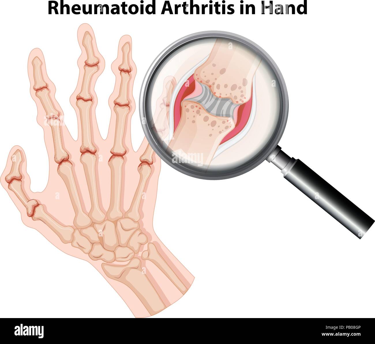 Rheumatoid arthritis drawing Stock Vector Images - Alamy
