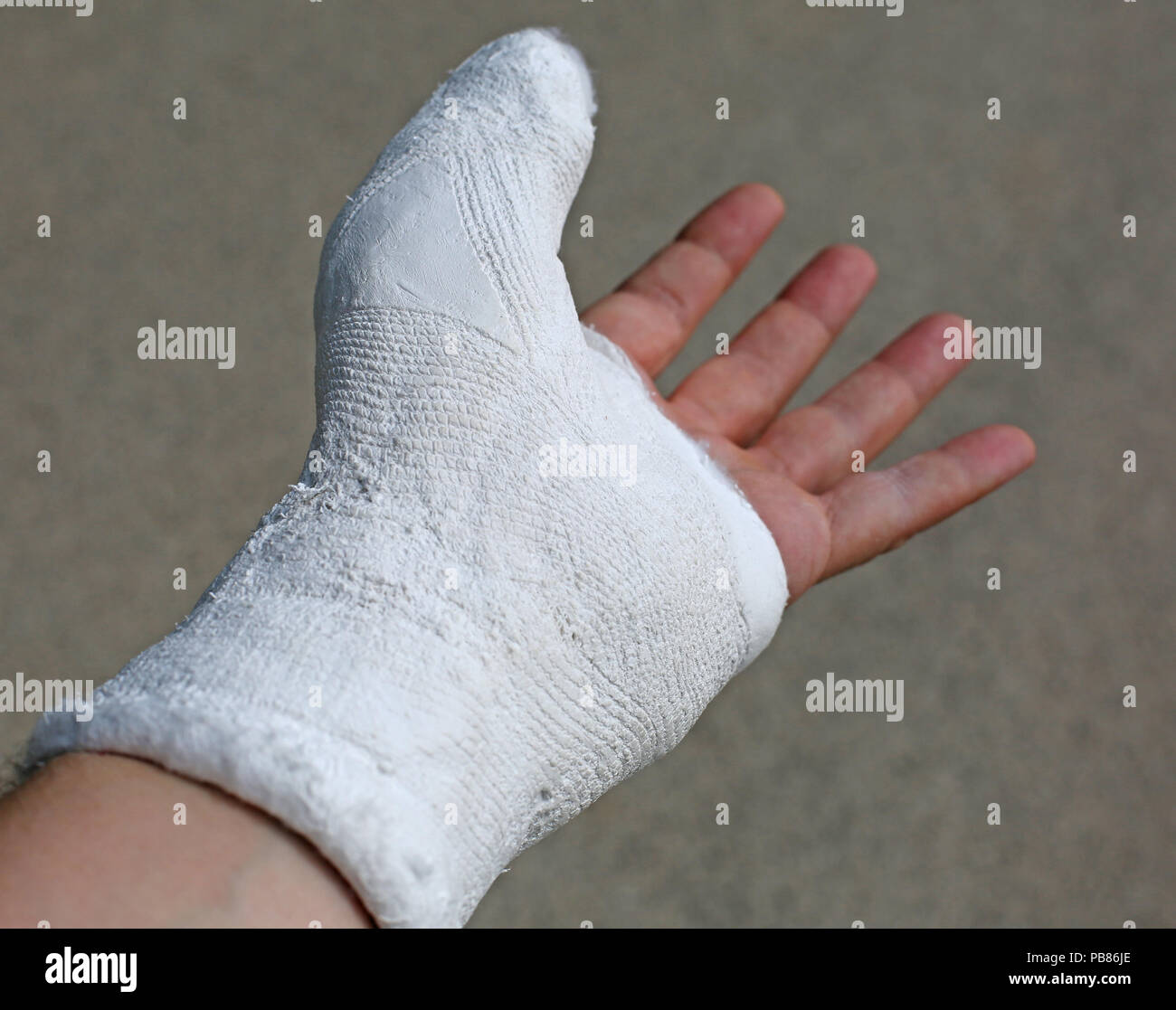 Plaster After Wrist Fracture High Resolution Stock Photography and ...